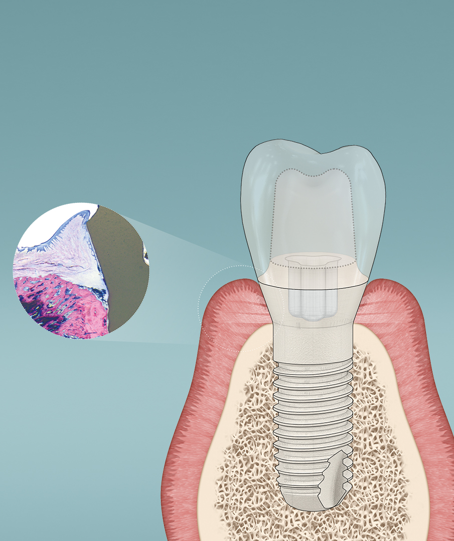 Patent™ - Implant Dentistry Without Peri-Implantitis