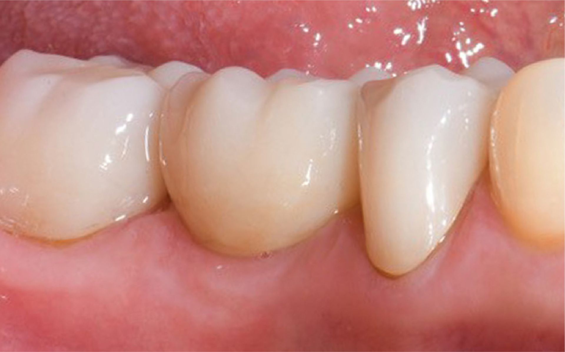 Patent™ Symbionic Teeth – The Next Generation in Tooth Replacement